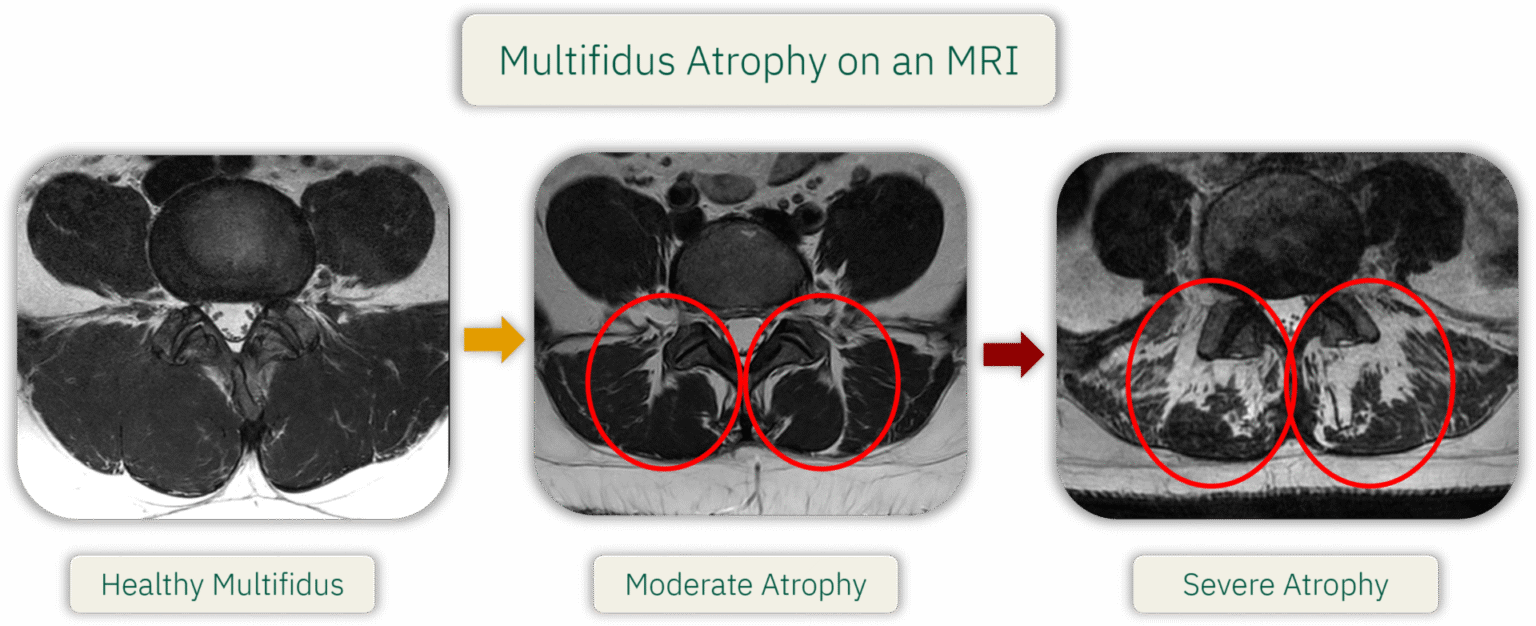 Pros and Cons of RFA in Treating Chronic Low Back Pain - Mainstay Medical