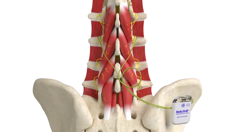ReActiv8-Me - Mainstay Medical