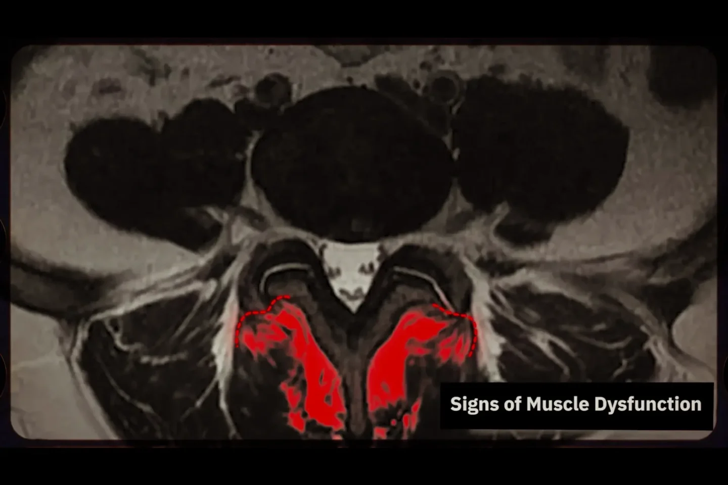 ReActiv8-Me - Mainstay Medical